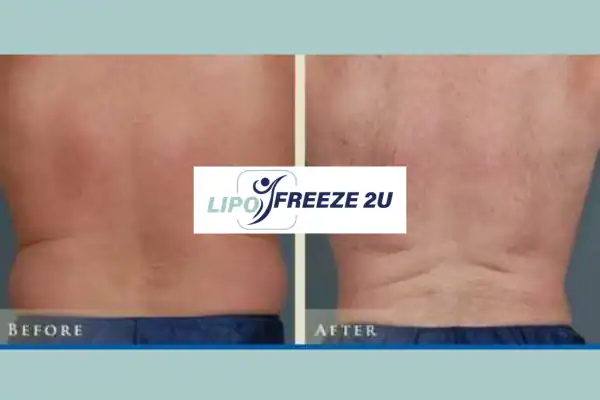 Fat Freezing Treatment Hampton Court Non-Surgical Fat Reduction
